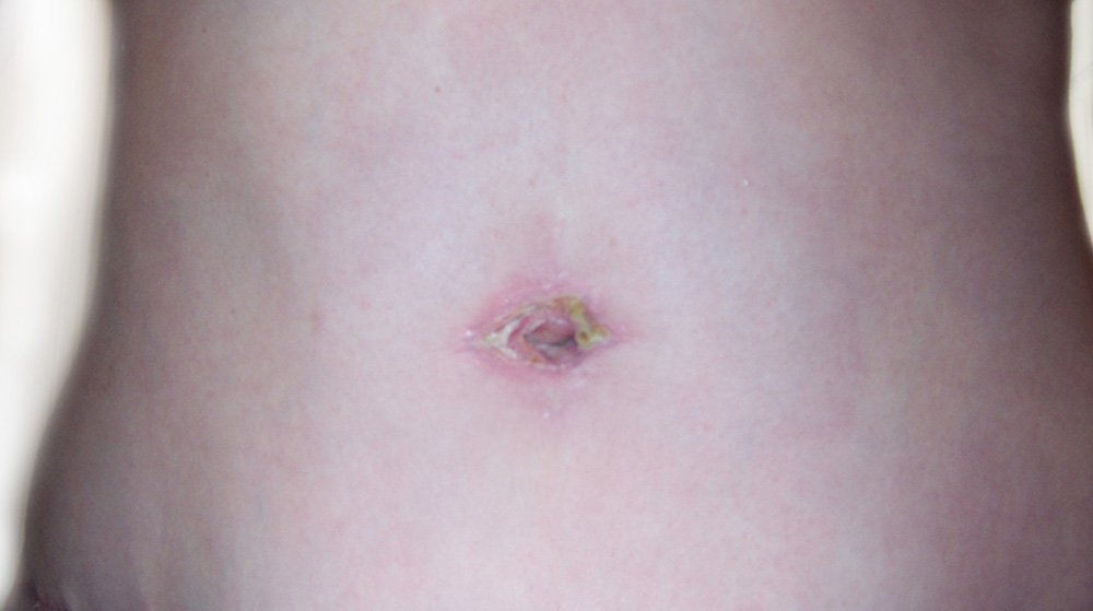 How To Clean Belly Button After Tummy Tuck Expert Tips