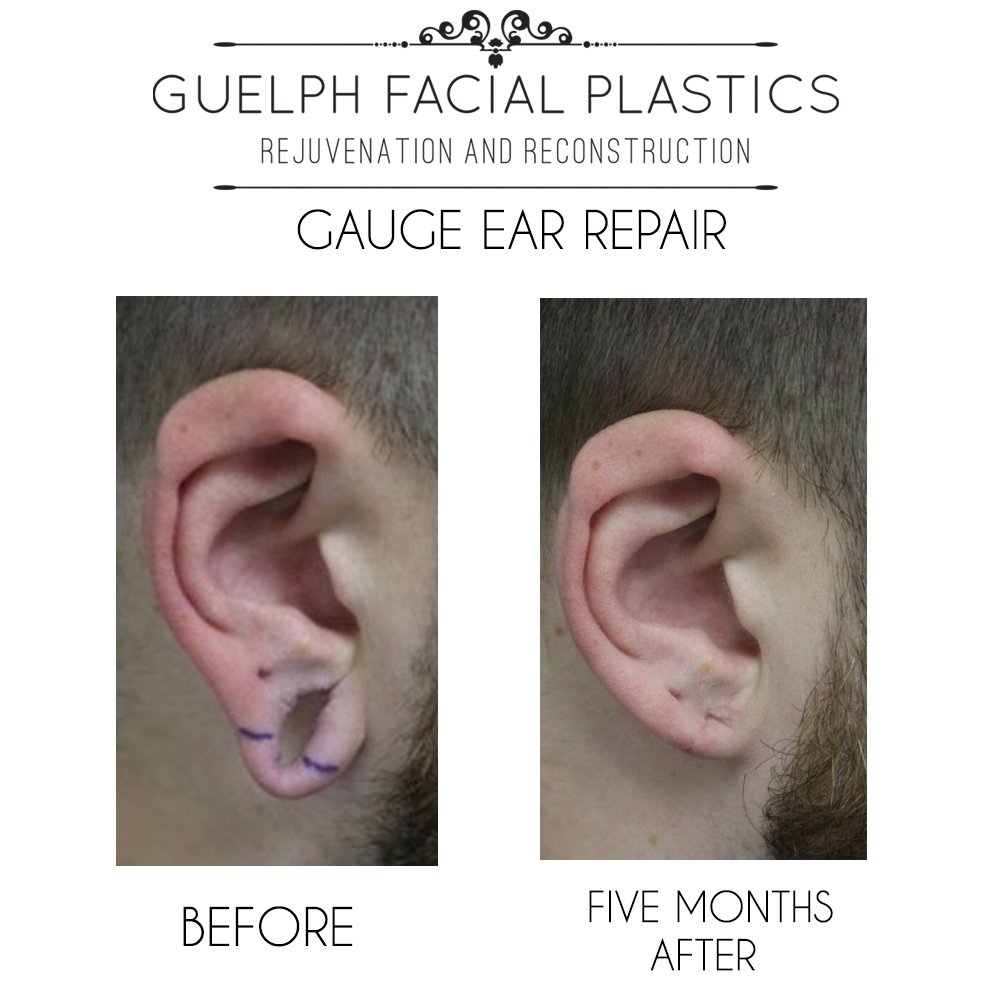 How to Clean Gauged Ears: Expert Tips for Safe Cleaning