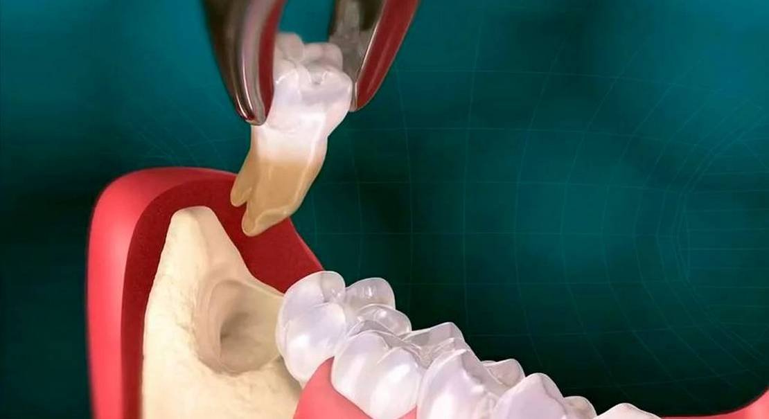 How to Clean under Gum Flap Wisdom Tooth: Expert Tips
